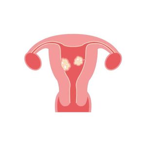 What are fibroids and their symptoms? - NESHA Medical Practice